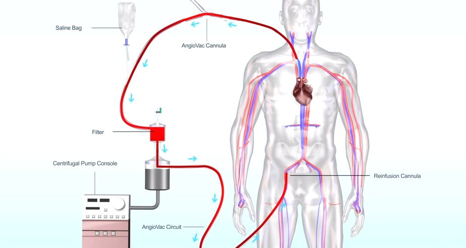 UC San Diego Can Remove Blood Clots Without Open-Heart Surgery - Times ...
